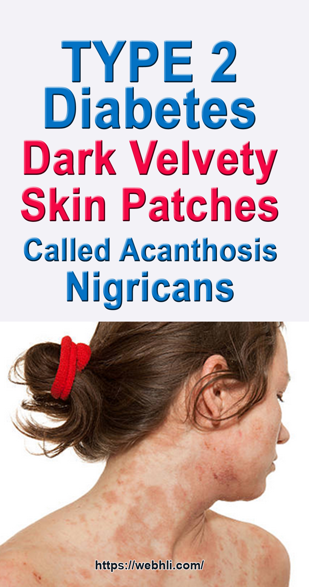 Type 2 Diabetes – Dark Velvety Skin Patches Called Acanthosis Nigricans ...