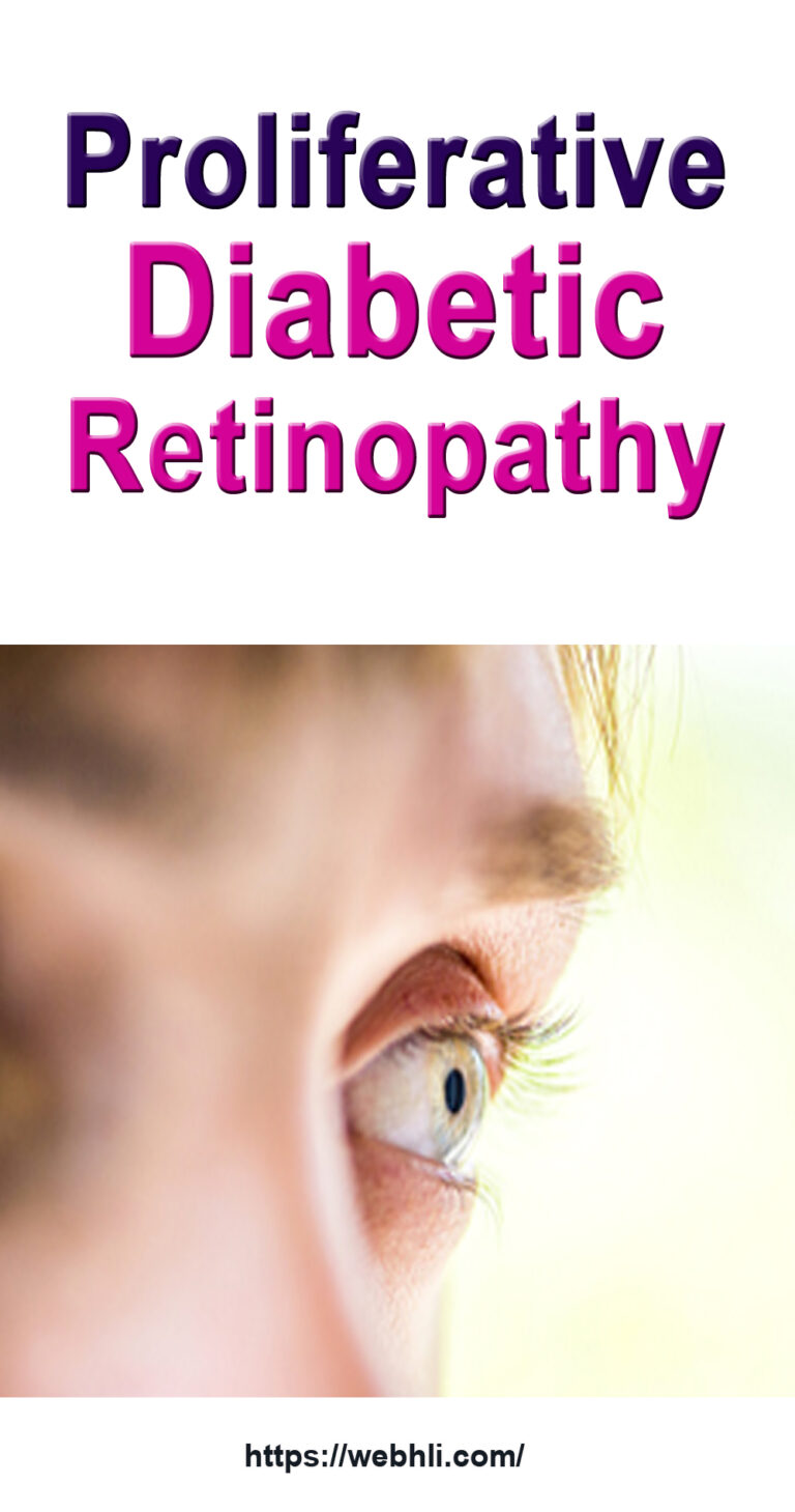 Proliferative Diabetic Retinopathy | Healthy Lifestyle