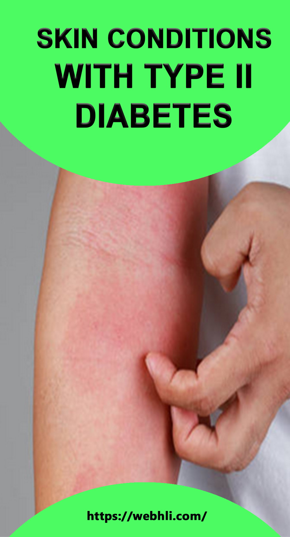 Skin Conditions With Type 2 Diabetes! | Healthy Lifestyle
