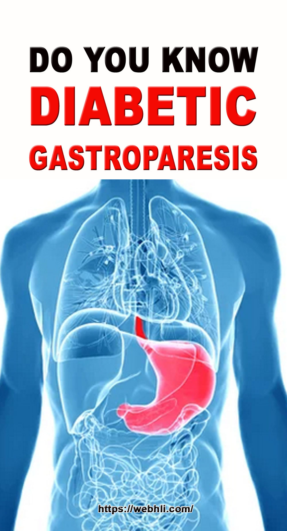 Do You Know Diabetic Gastroparesis is a Complication Many Type 2 ...